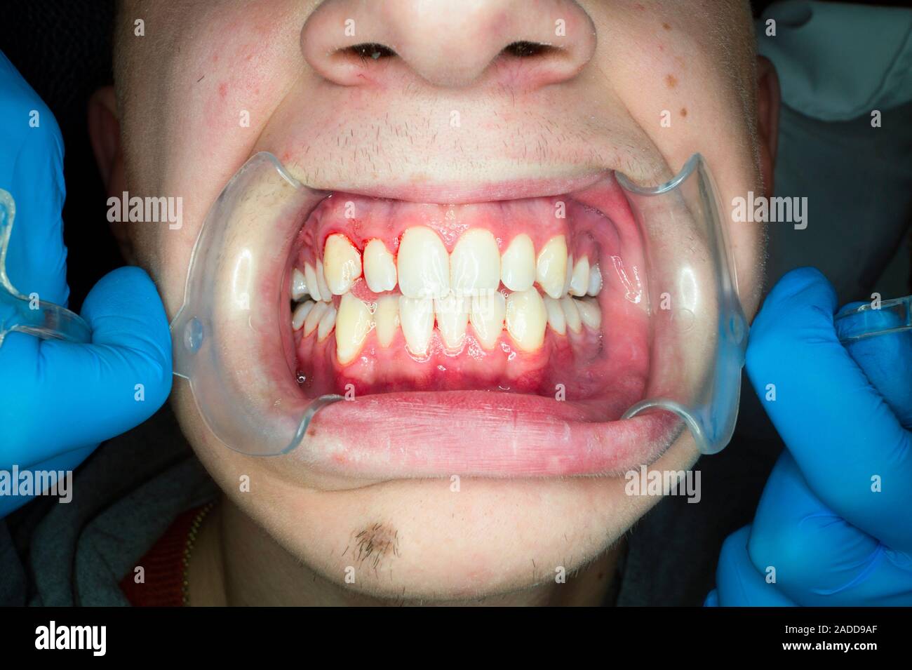 Over bite. Close-up of the mouth of a man with a normal overbite of the ...