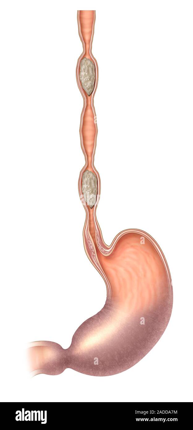 Oesophagus and stomach, illustration. At top, food from the mouth has ...