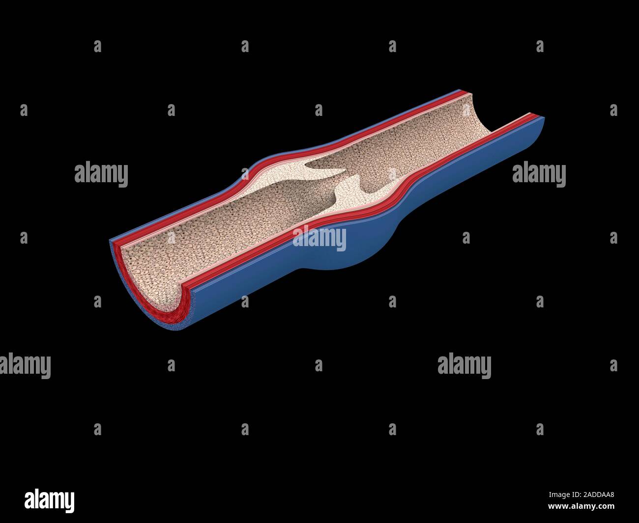 Vein valve. Computer illustration of a section through a vein, showing ...