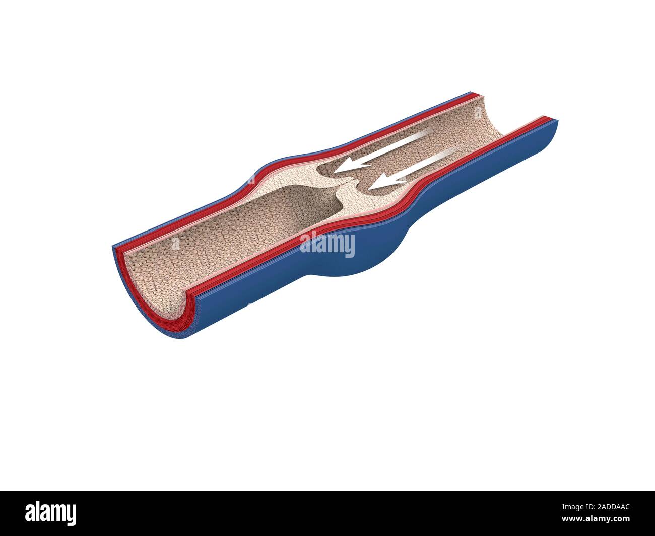 Vein valve. Computer illustration of a section through a vein, showing ...