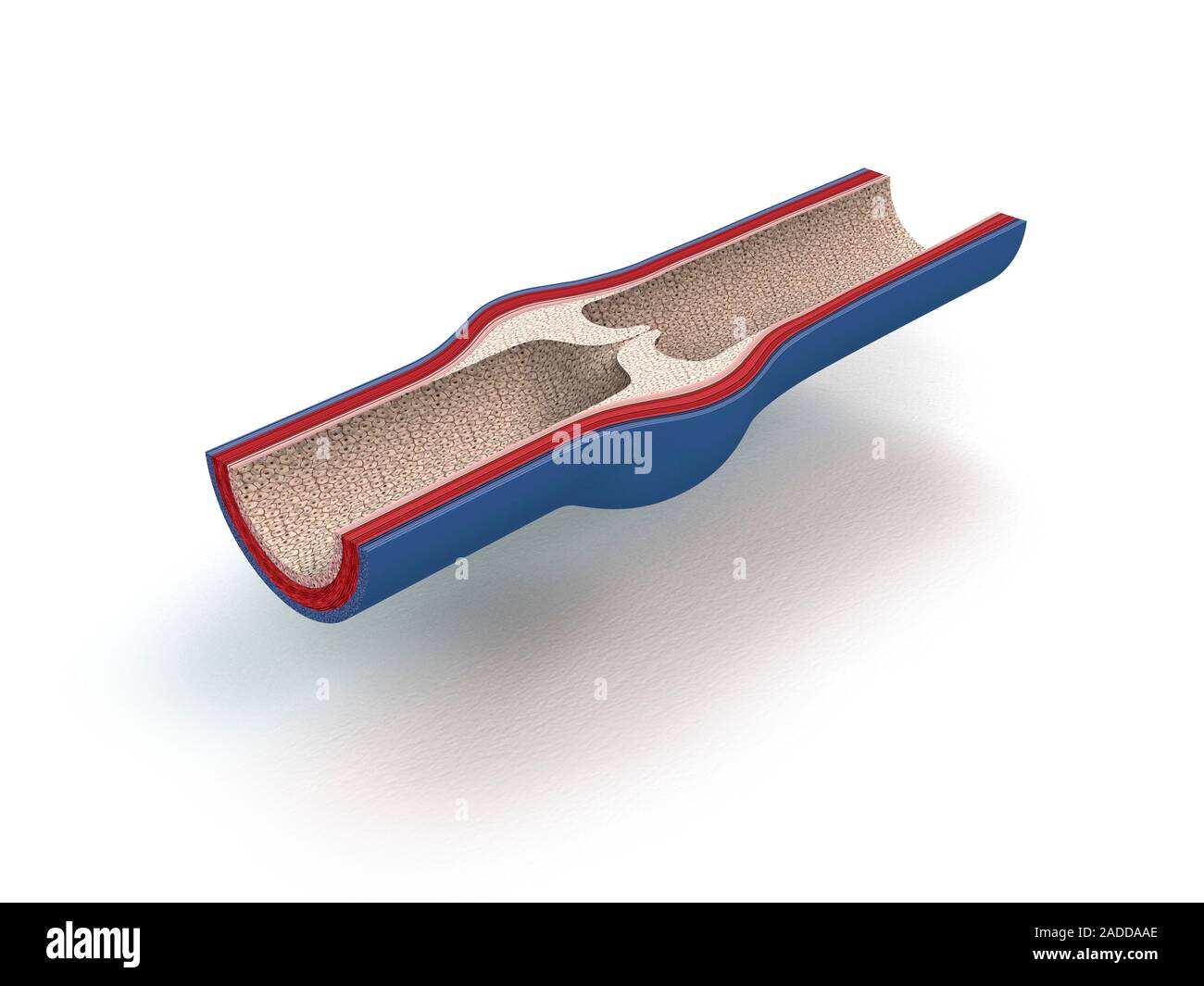 Vein valve. Computer illustration of a section through a vein, showing ...