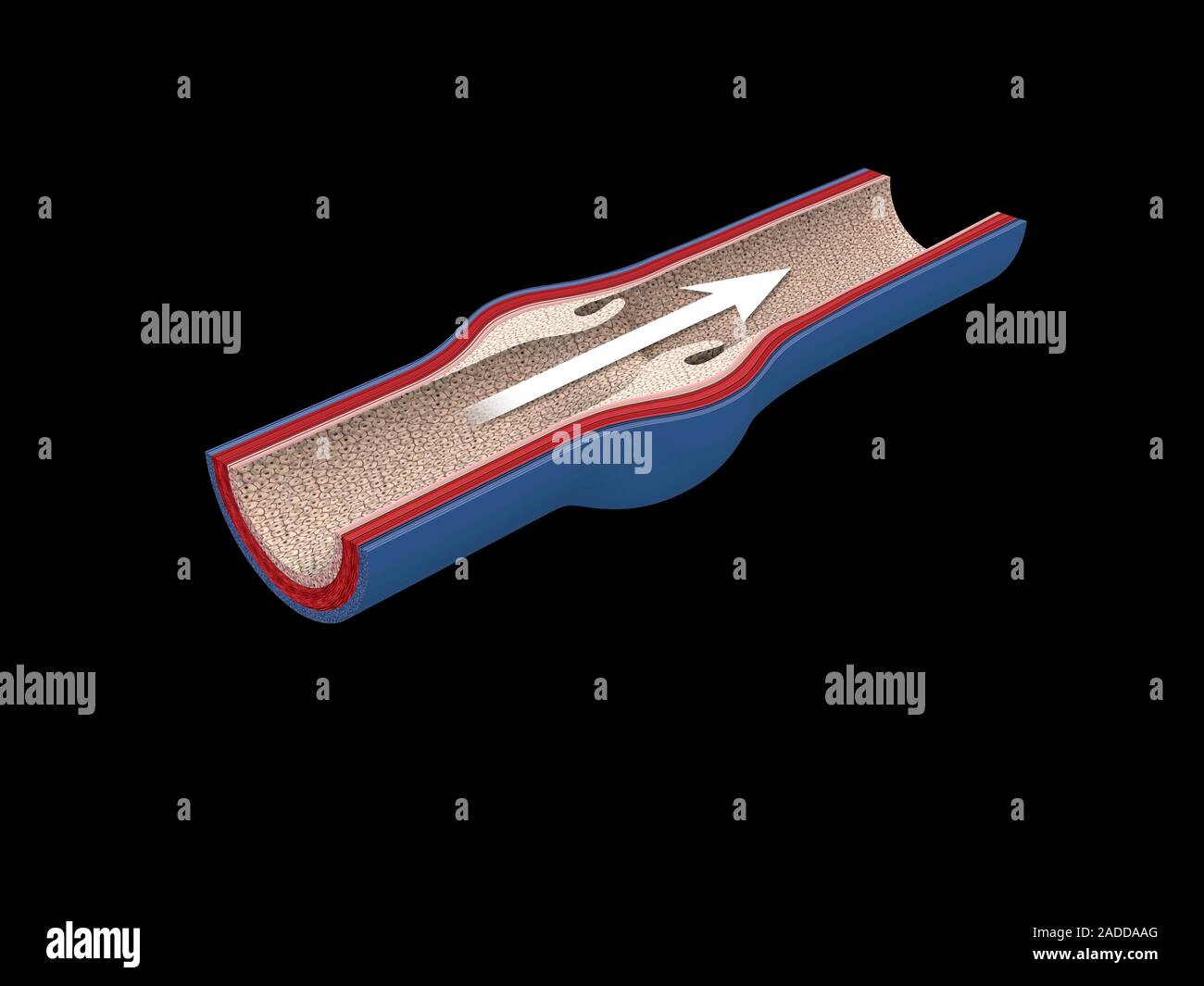 Vein valve. Computer illustration of a section through a vein, showing ...