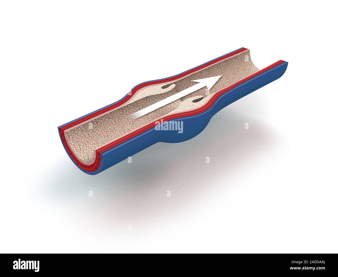 Vein valve. Computer illustration of a section through a vein, showing ...