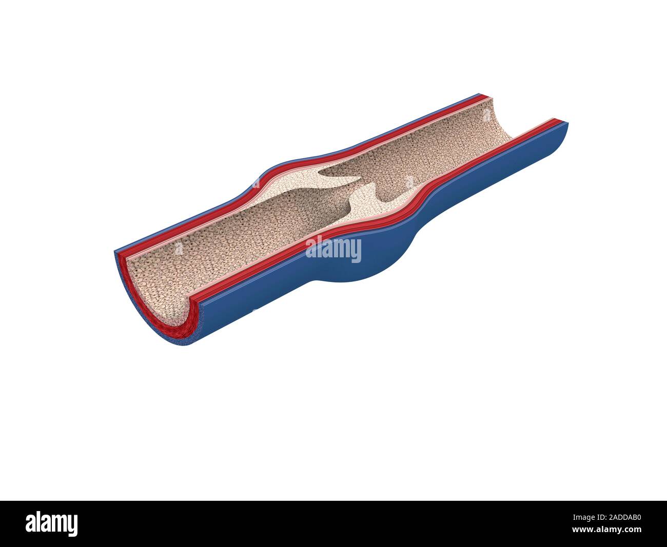 Vein valve. Computer illustration of a section through a vein, showing ...