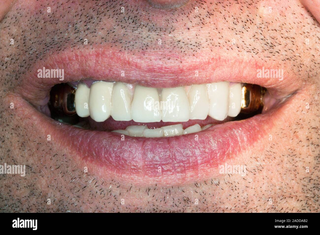 Dental bridge. Close-up of the lower jaw of a 45-year-old man who has ...