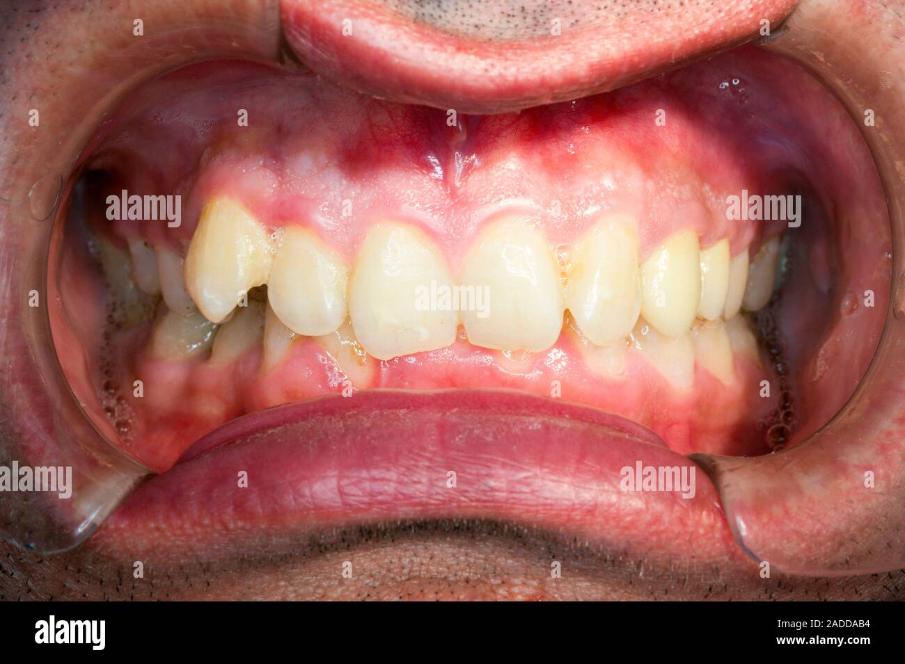 Dental malocclusion. Close-up of the mouth of a patient with a dental ...
