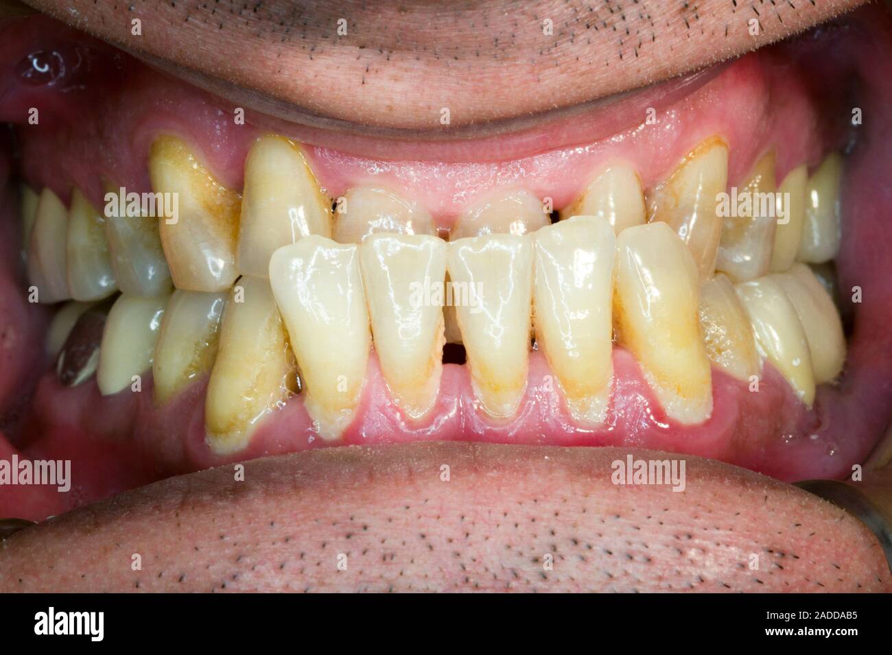 Back bite. Close-up of the mouth of a patient with a back bite, showing ...