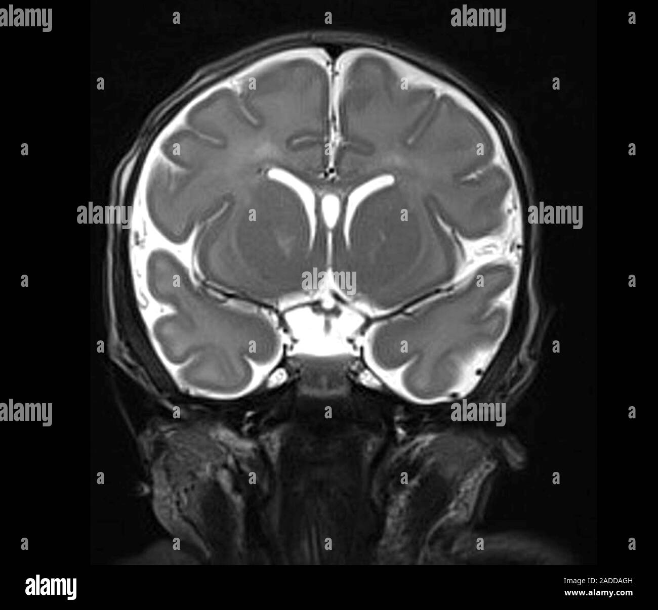 Brain ventricle anomaly. Coronal magnetic resonance imaging (MRI) scan ...
