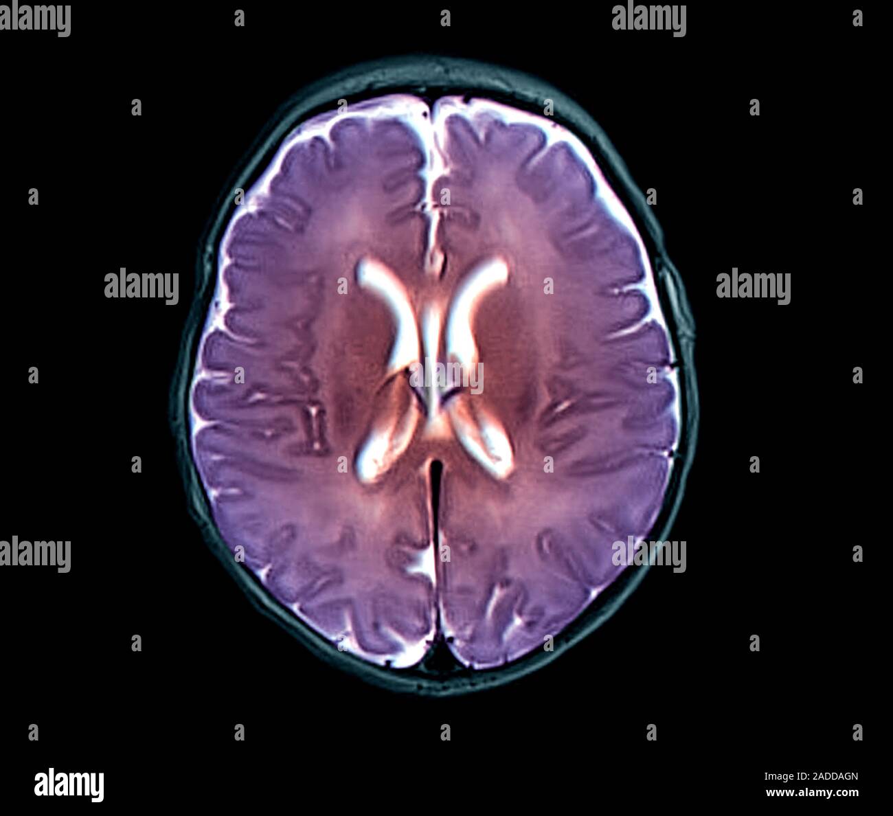 Brain ventricle anomaly. Coloured axial magnetic resonance imaging (MRI ...