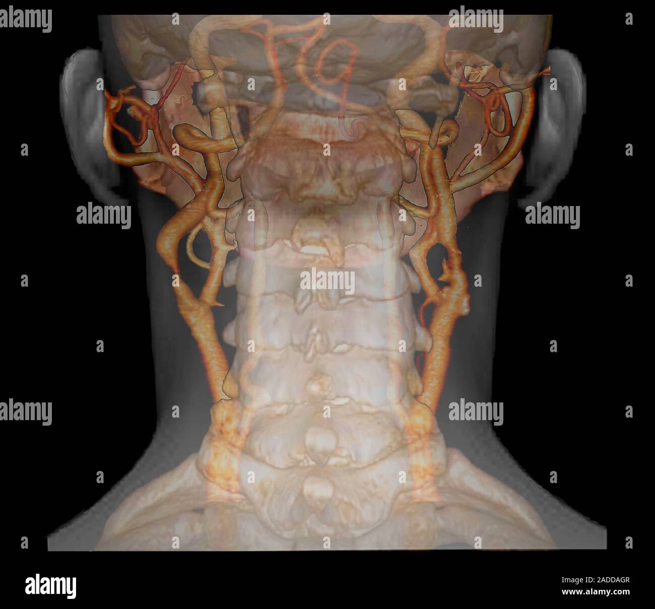 Atherosclerosis in neck arteries. 3D coloured computed tomography (CT) scan and angiogram of the ...