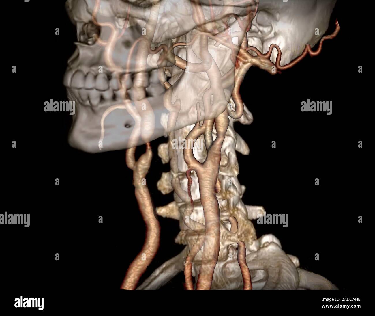 Atherosclerosis in neck arteries. 3D coloured computed tomography (CT) scan and angiogram of the ...