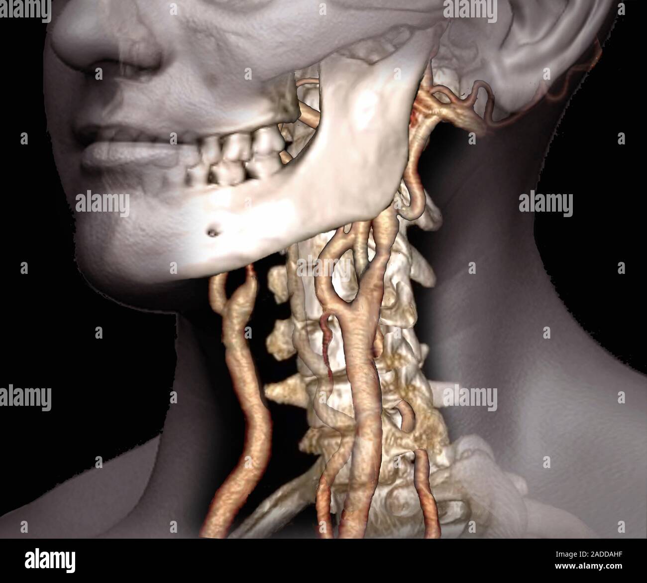 Atherosclerosis in neck arteries. 3D coloured computed tomography (CT ...