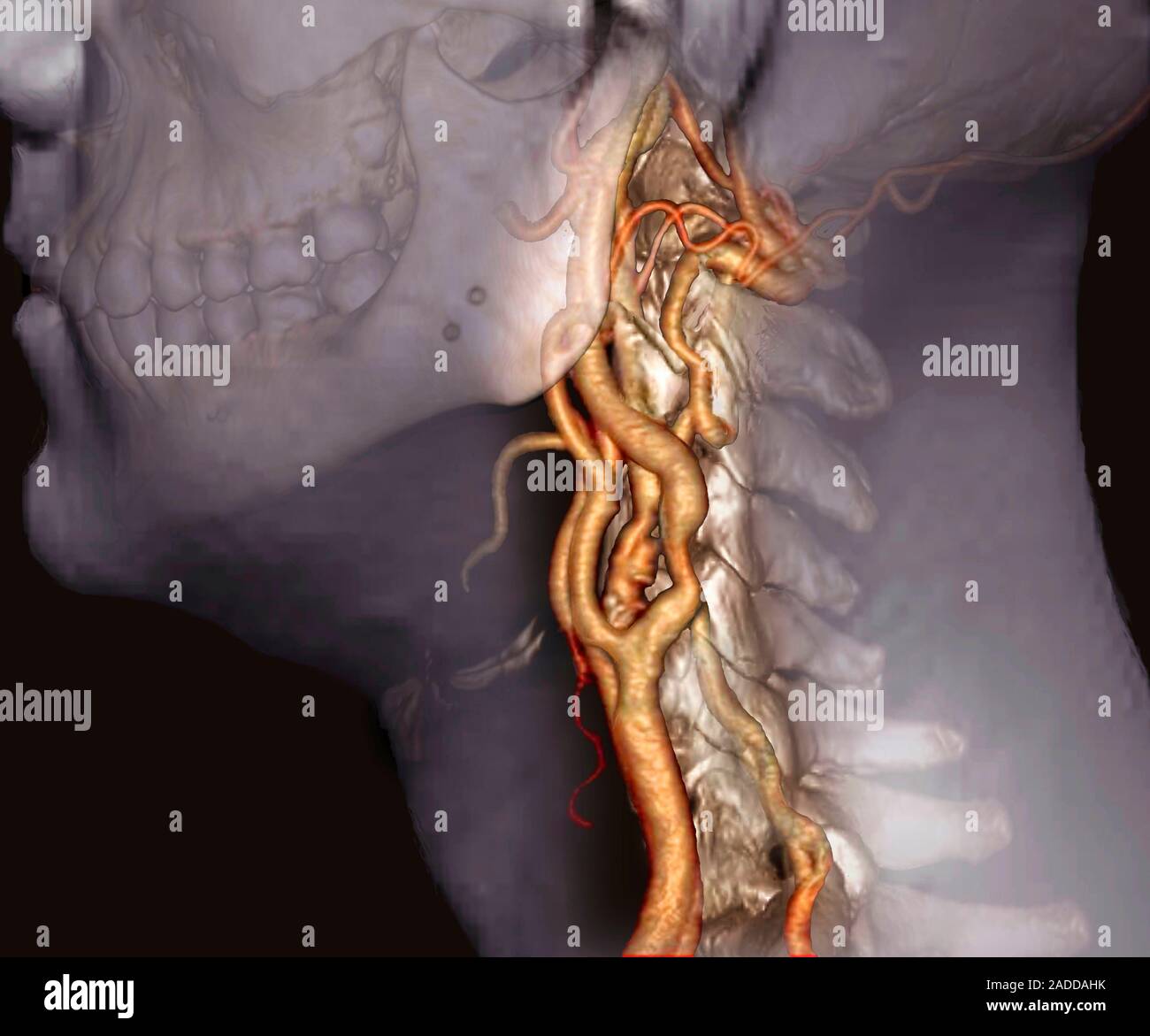Atherosclerosis in neck arteries. 3D coloured computed tomography (CT) scan and angiogram of the ...