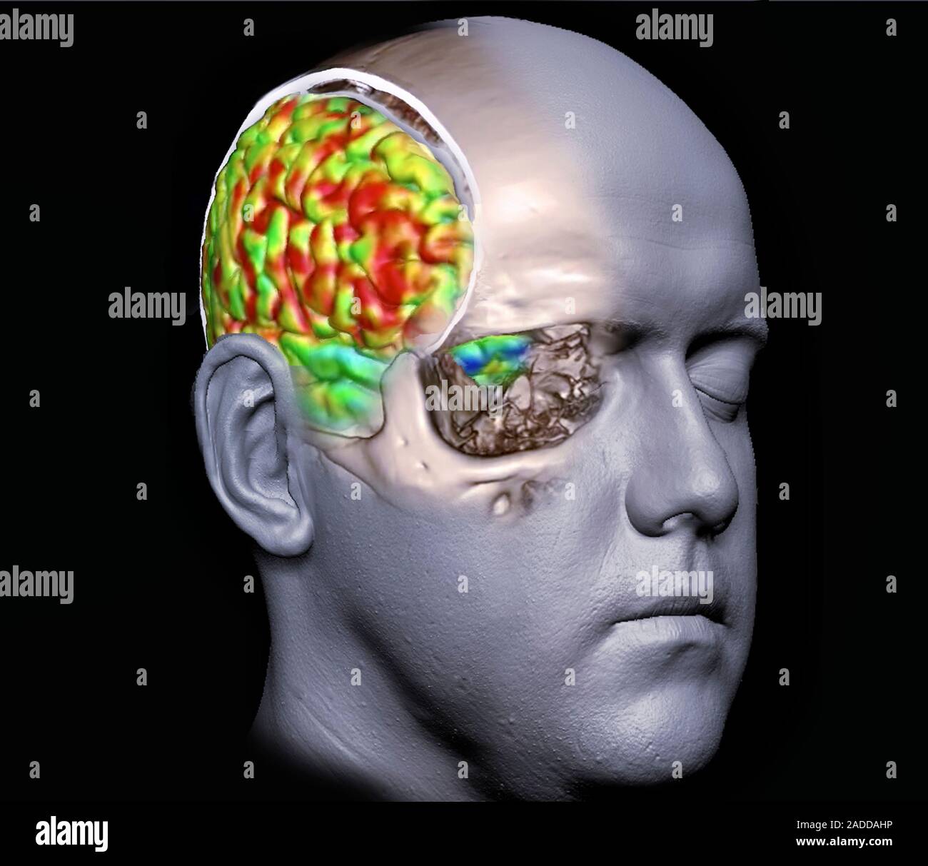 Human Brains Right Hemisphere Coloured Functional Magnetic Resonance Imaging Fmri Scan Of