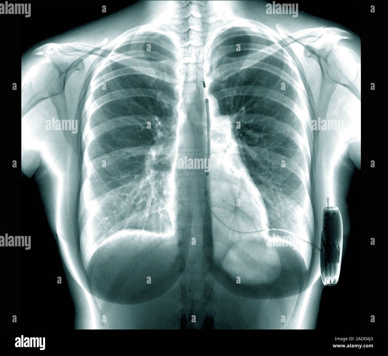 Cardiac defibrillator. Coloured X-ray of the chest of a 27-year-old ...