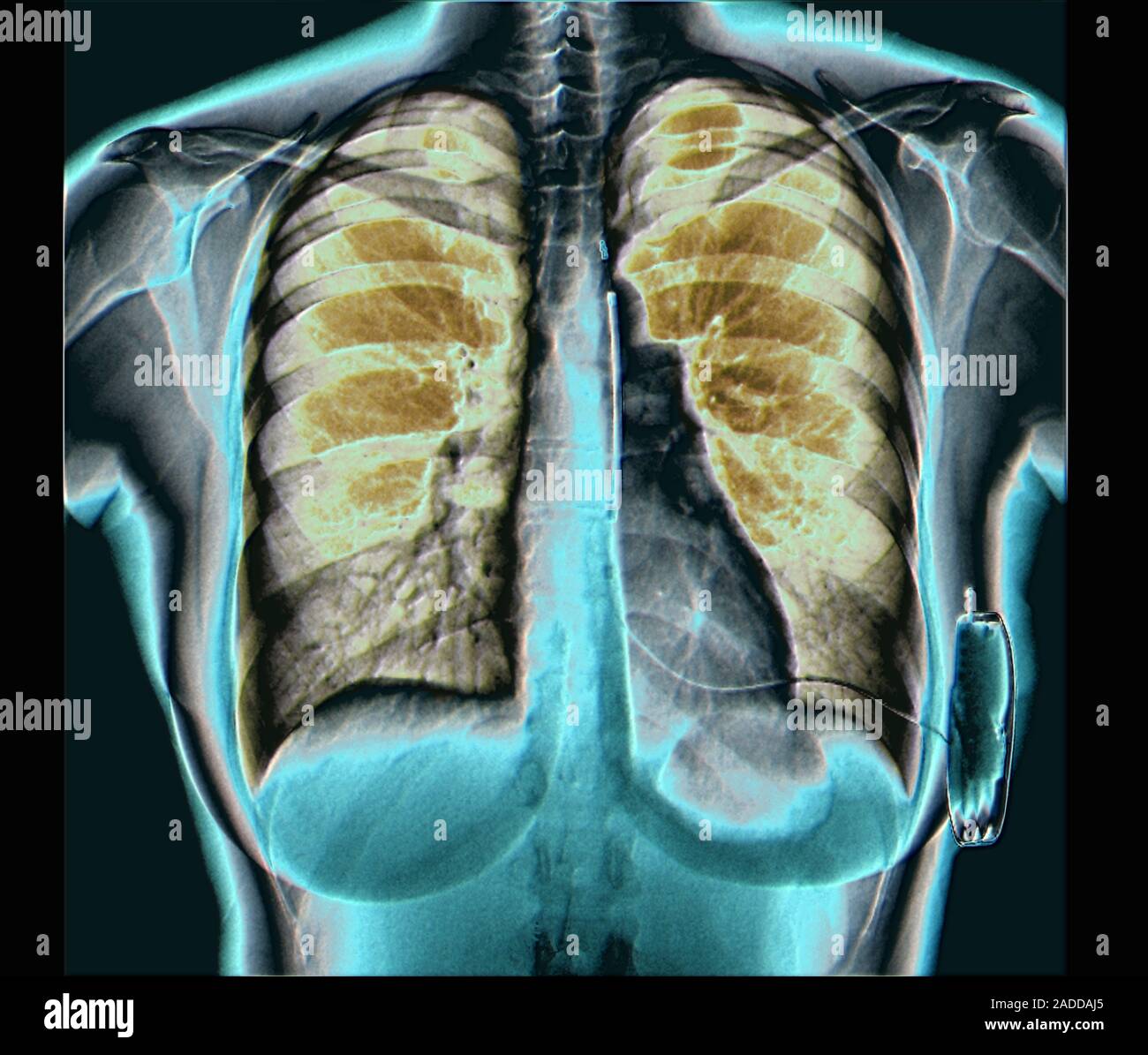 Cardiac defibrillator. Coloured X-ray of the chest of a 27-year-old ...
