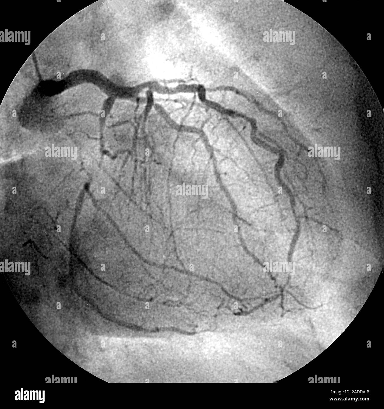Coronary artery stenosis. Coronarography (contrast medium X-ray) scan ...