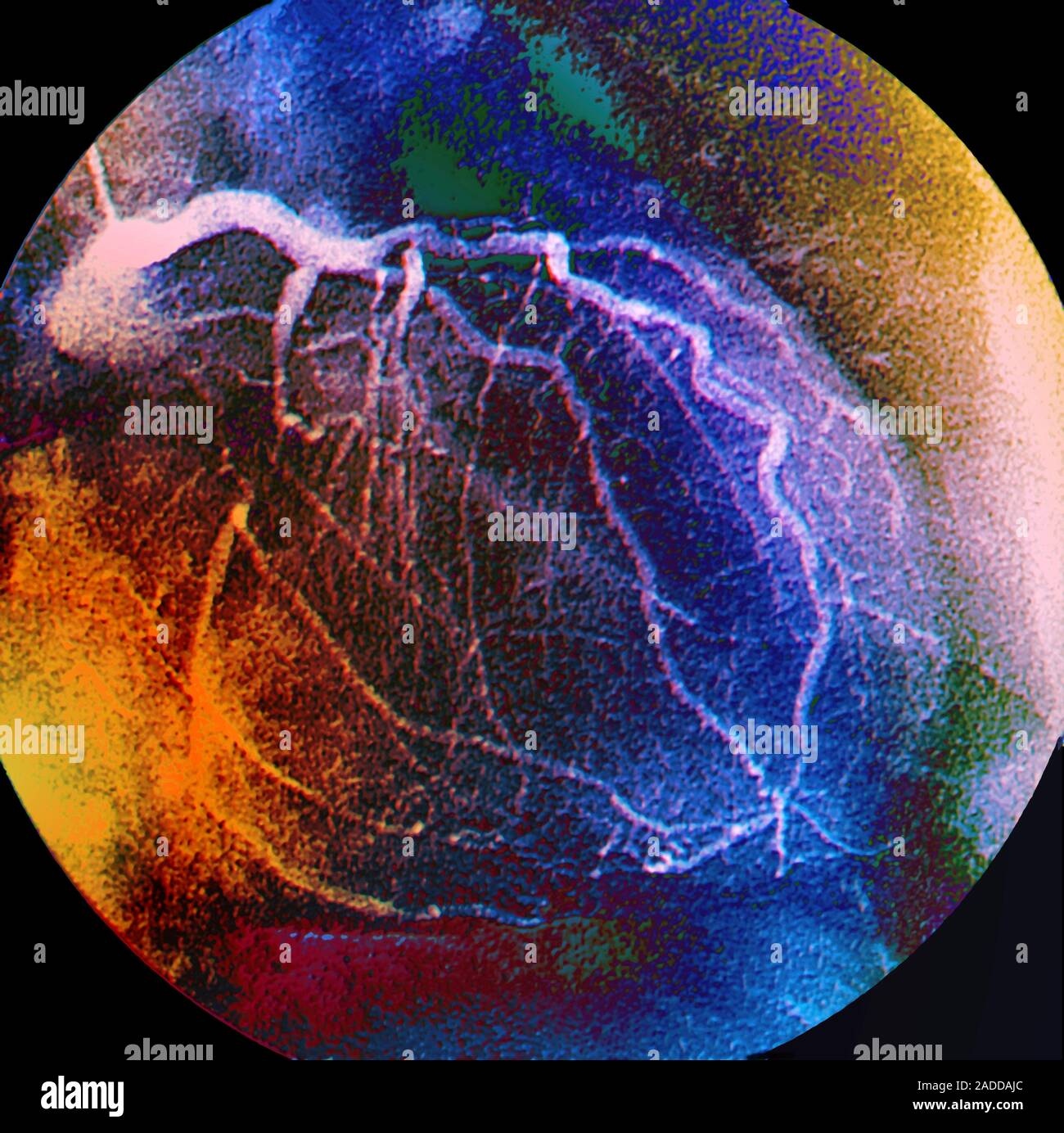 Coronary artery stenosis. Coloured coronarography (contrast medium X ...