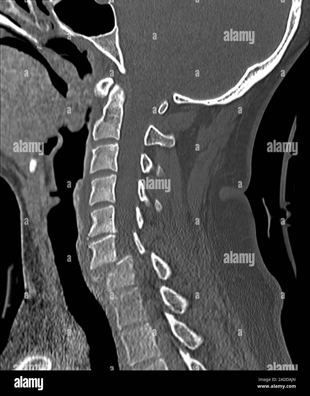 Whiplash neck injury. Sagittal computed tomography (CT) scan of the ...