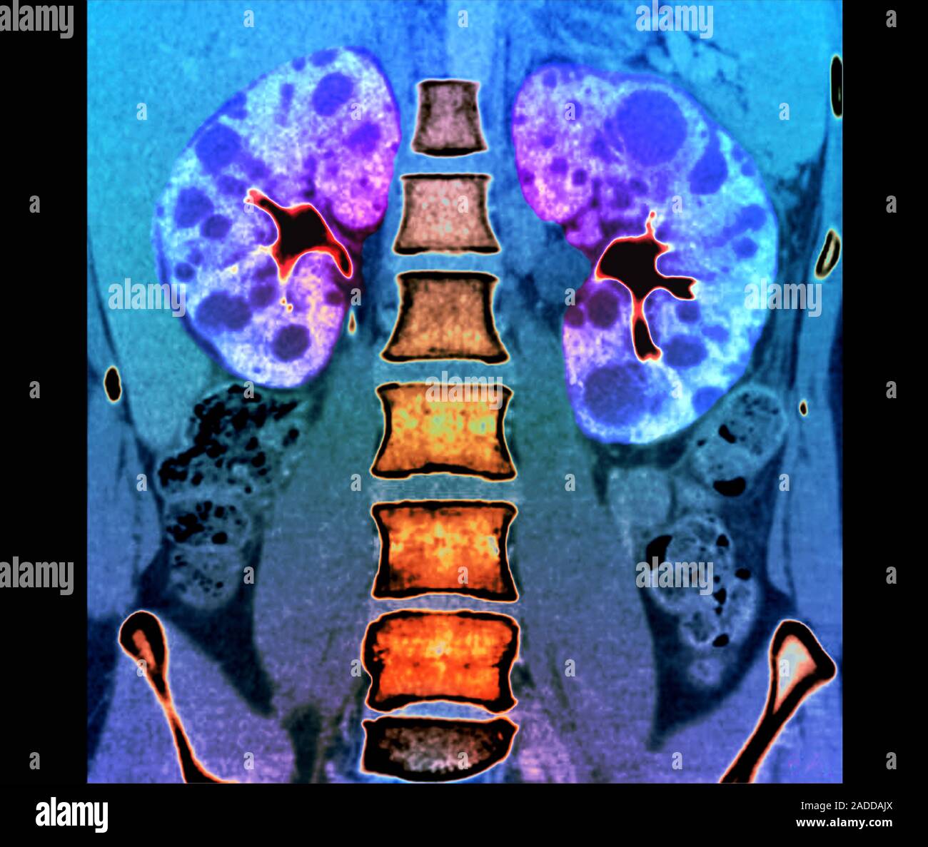 Polycystic kidneys. Coloured coronal computed tomography (CT) scan of ...