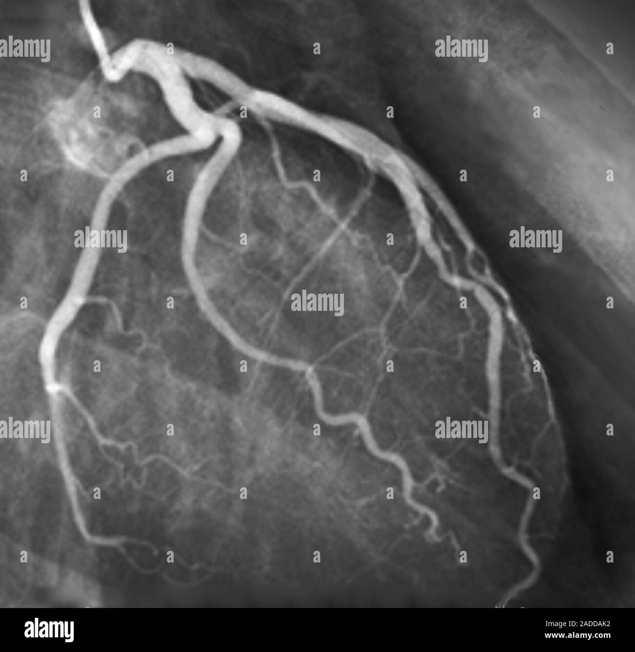 Left coronary artery. Coronarography (contrast medium X-ray) scan of ...