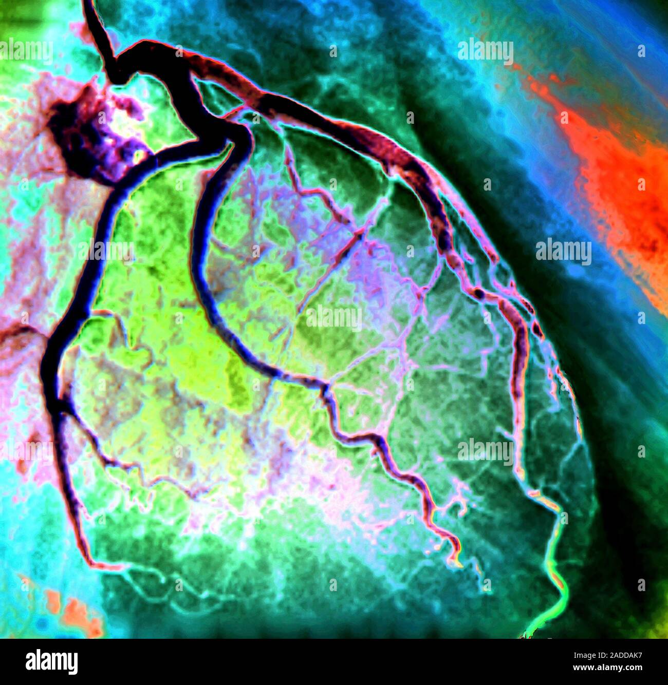 Left coronary artery. Coloured coronarography (contrast medium X-ray ...