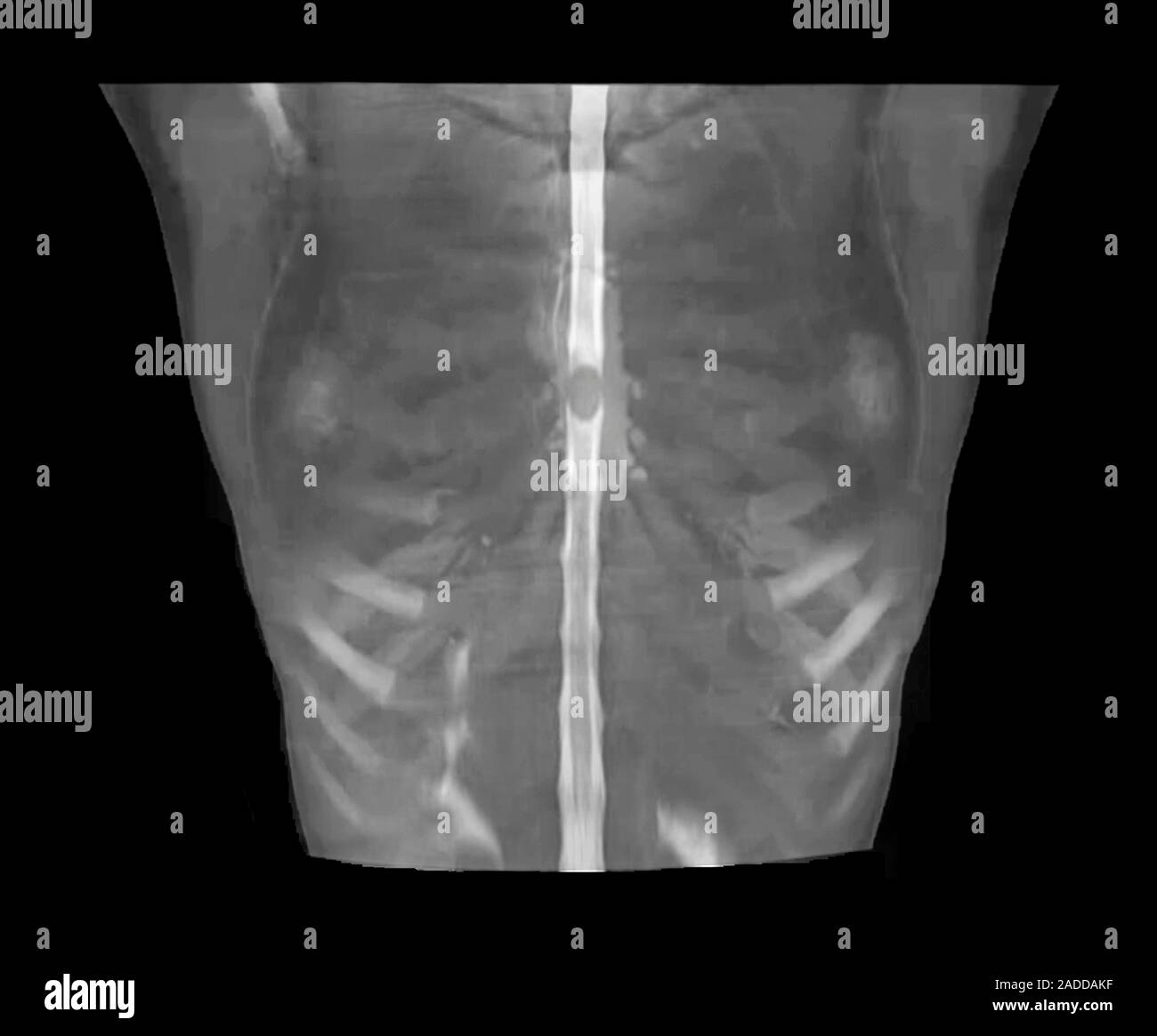 Spinal cord tumour. Coronal computed tomography (CT) myelography ...