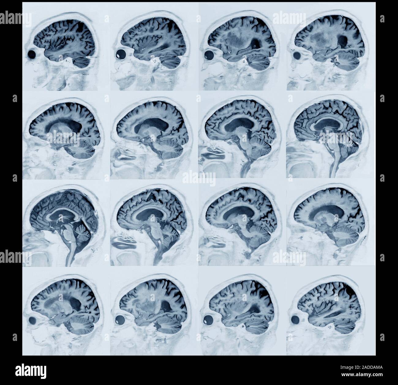 Alzheimers Disease Mri