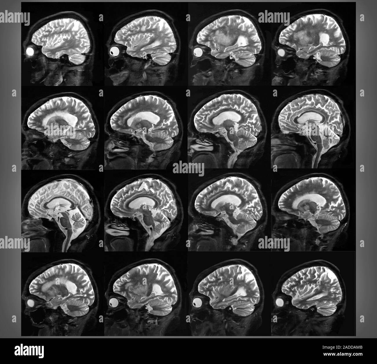 Alzheimers Disease Array Of Sagittal Magnetic Resonance Imaging Mri Scans Of The Brain Of A
