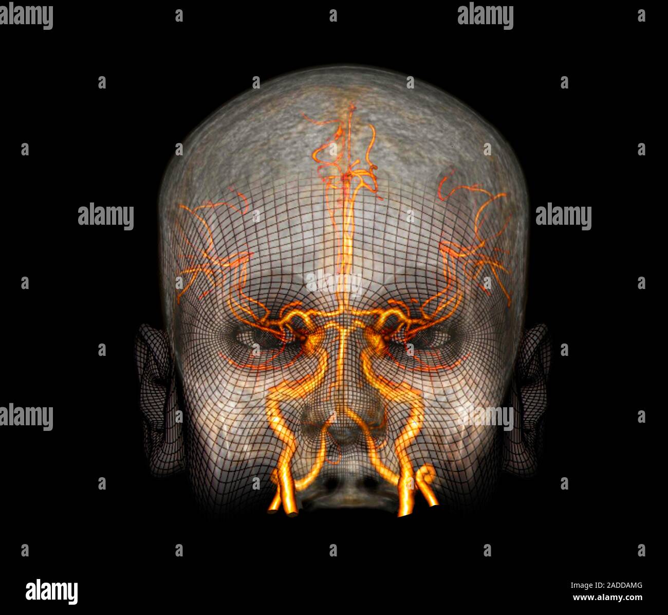 Brain and neck arteries. Coloured frontal 3D computed tomography (CT ...