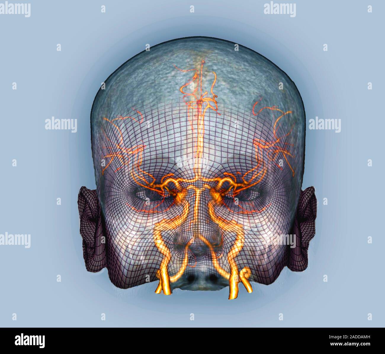 Brain and neck arteries. Coloured frontal 3D computed tomography (CT) angiogram, combined with a ...