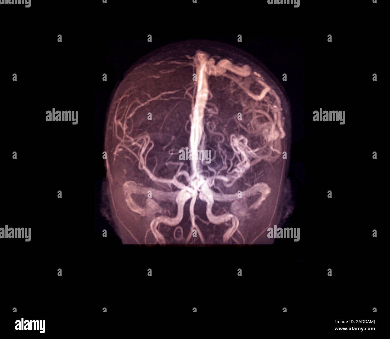 Cerebral Arteriovenous Malformation Coloured Frontal 3d Computed Tomography Ct Angiogram Scan