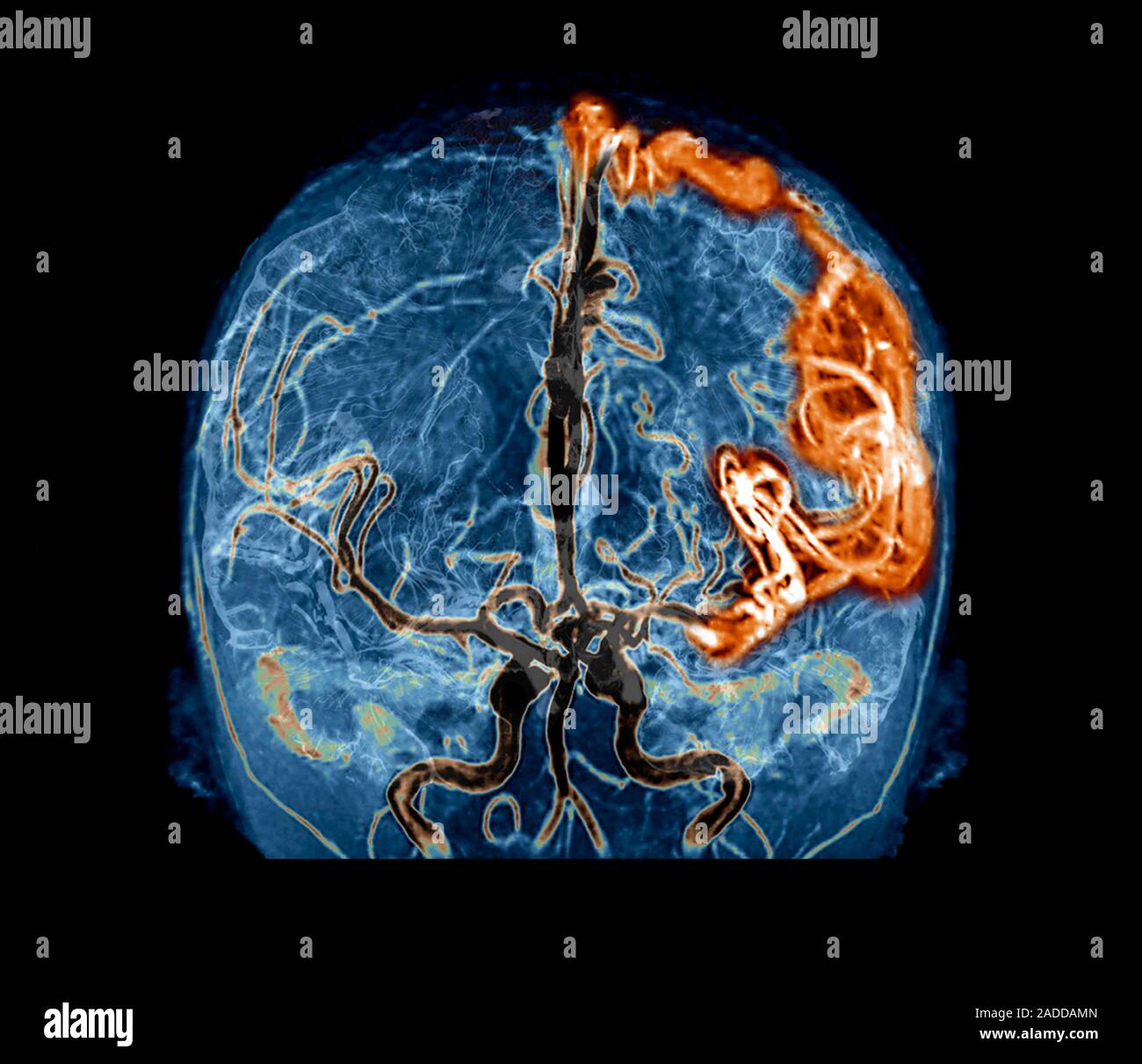 Cerebral arteriovenous malformation. Coloured frontal 3D computed tomography (CT) angiogram scan ...