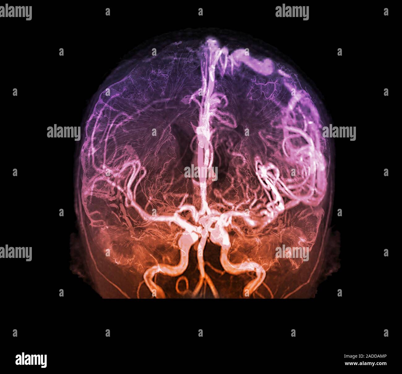 Cerebral arteriovenous malformation. Coloured frontal 3D computed tomography (CT) angiogram scan ...