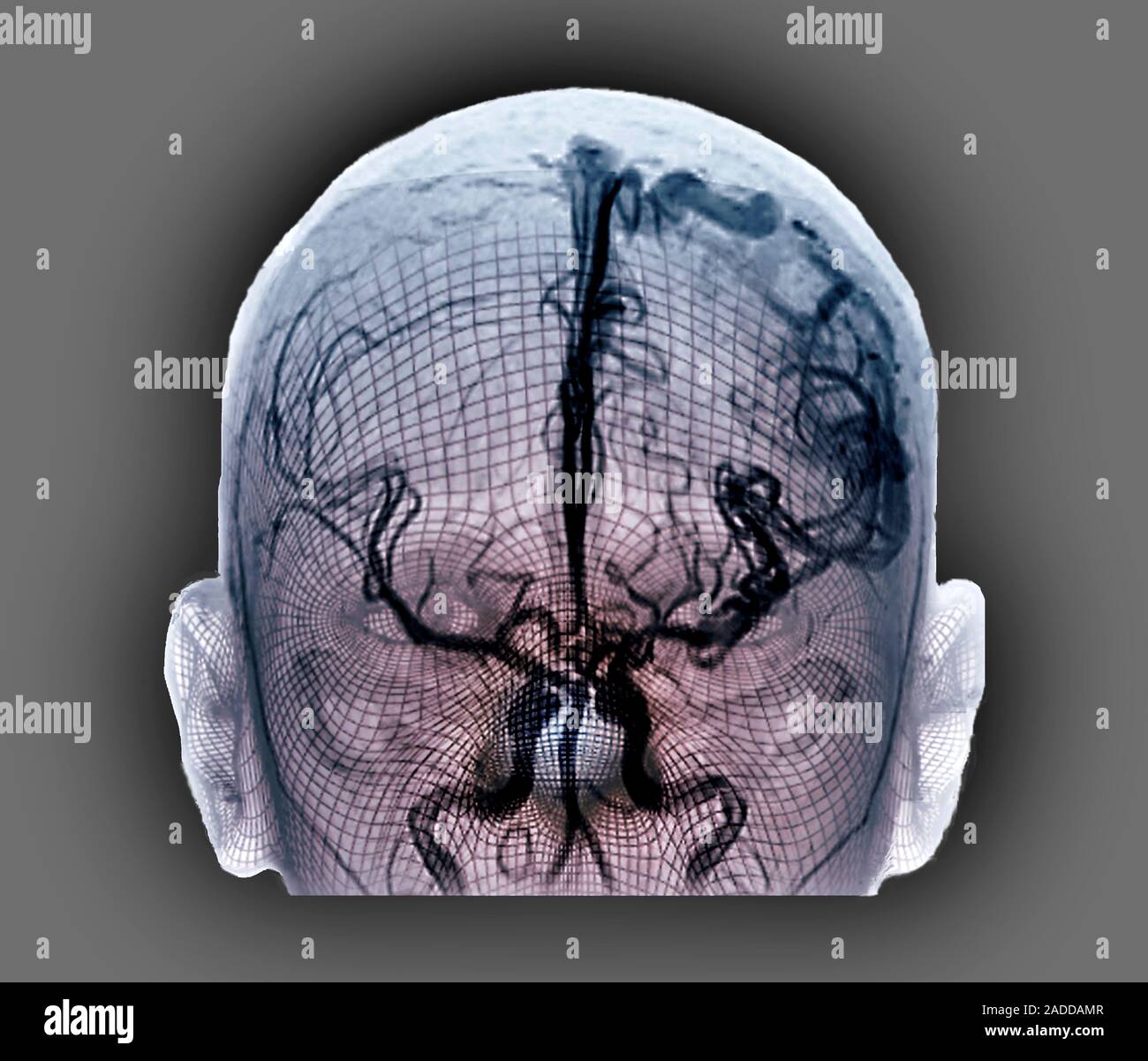 Cerebral arteriovenous malformation. Coloured frontal 3D computed tomography (CT) angiogram scan ...