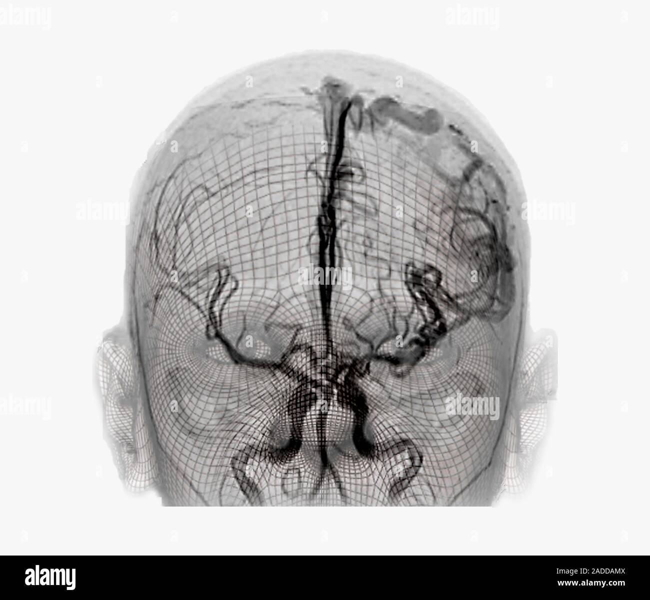 Cerebral arteriovenous malformation. Frontal 3D computed tomography (CT ...