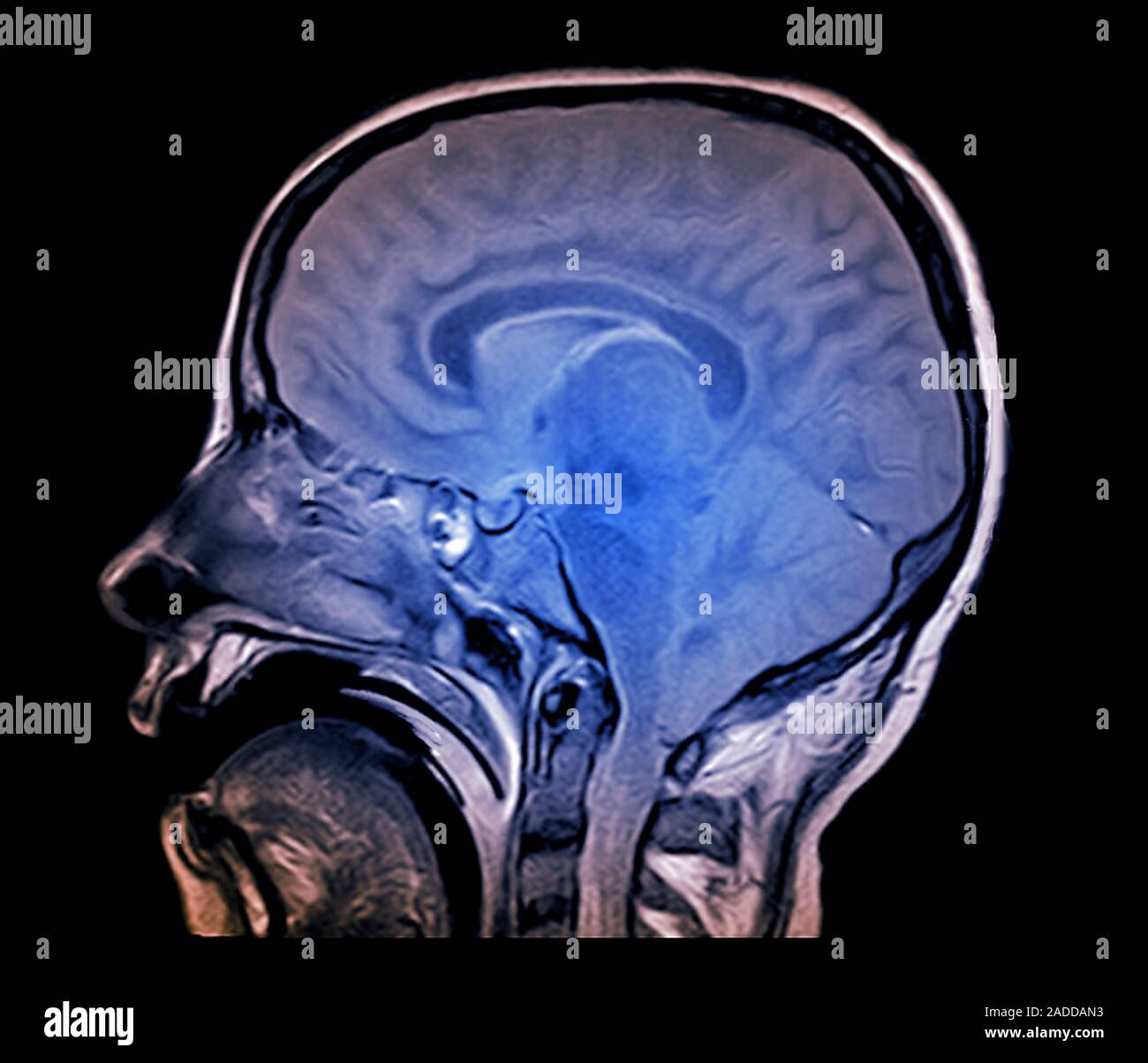Brain death test. Coloured sagittal magnetic resonance imaging (MRI ...