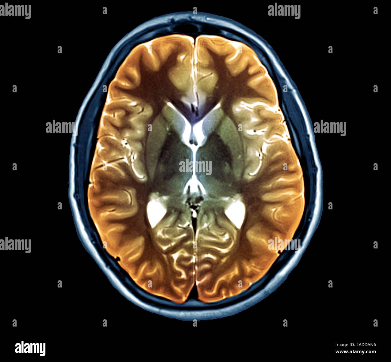 Human brain. Coloured axial magnetic resonance imaging (MRI) scan ...