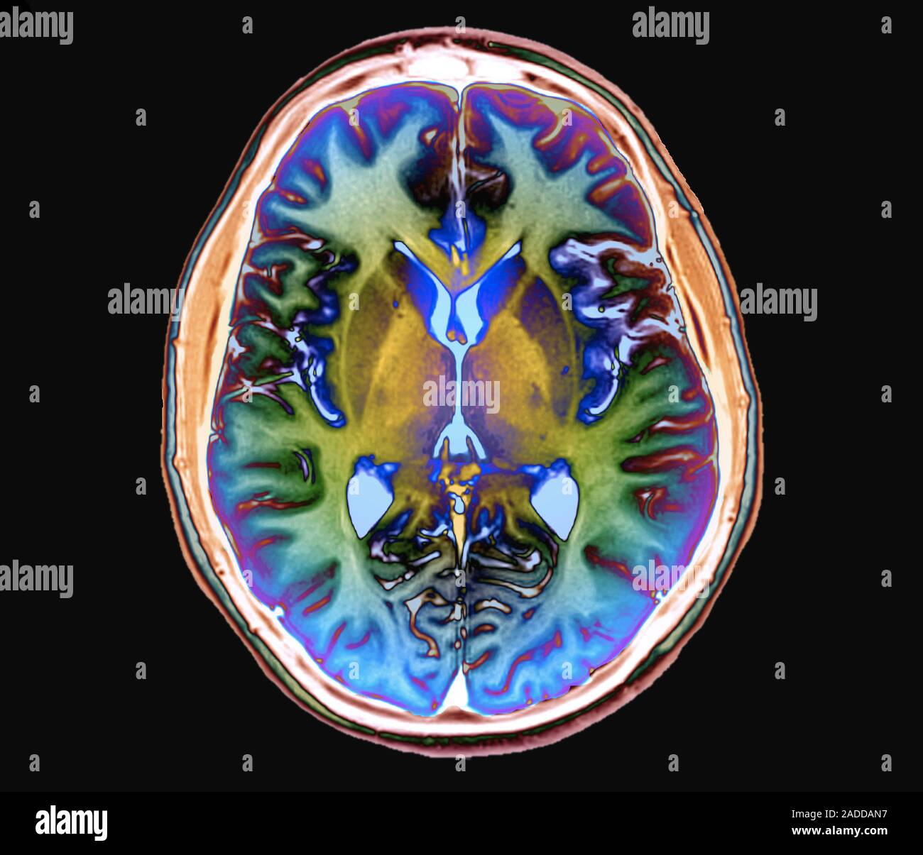 Human brain. Coloured axial magnetic resonance imaging (MRI) scan through the healthy brain of a ...