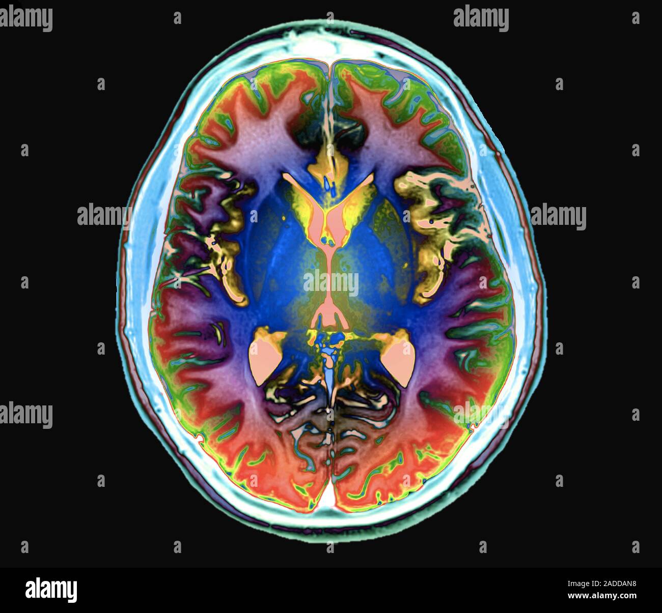 Human brain. Coloured axial magnetic resonance imaging (MRI) scan ...