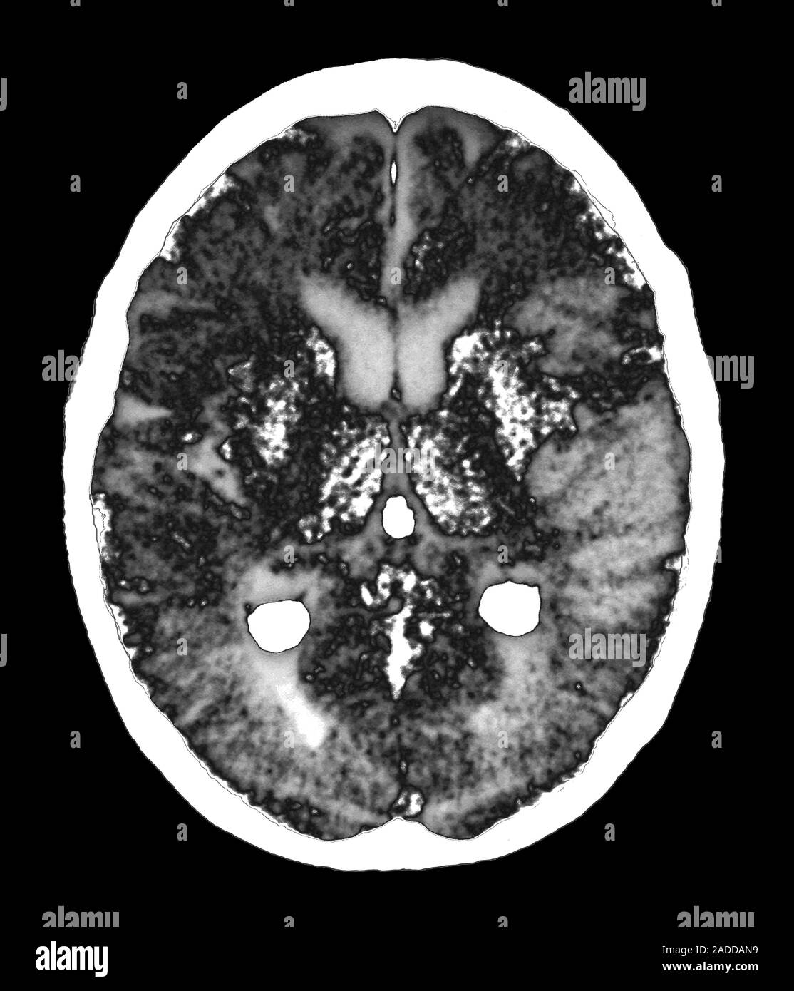 Stroke brain damage. Axial computed tomography (CT) scan through the ...