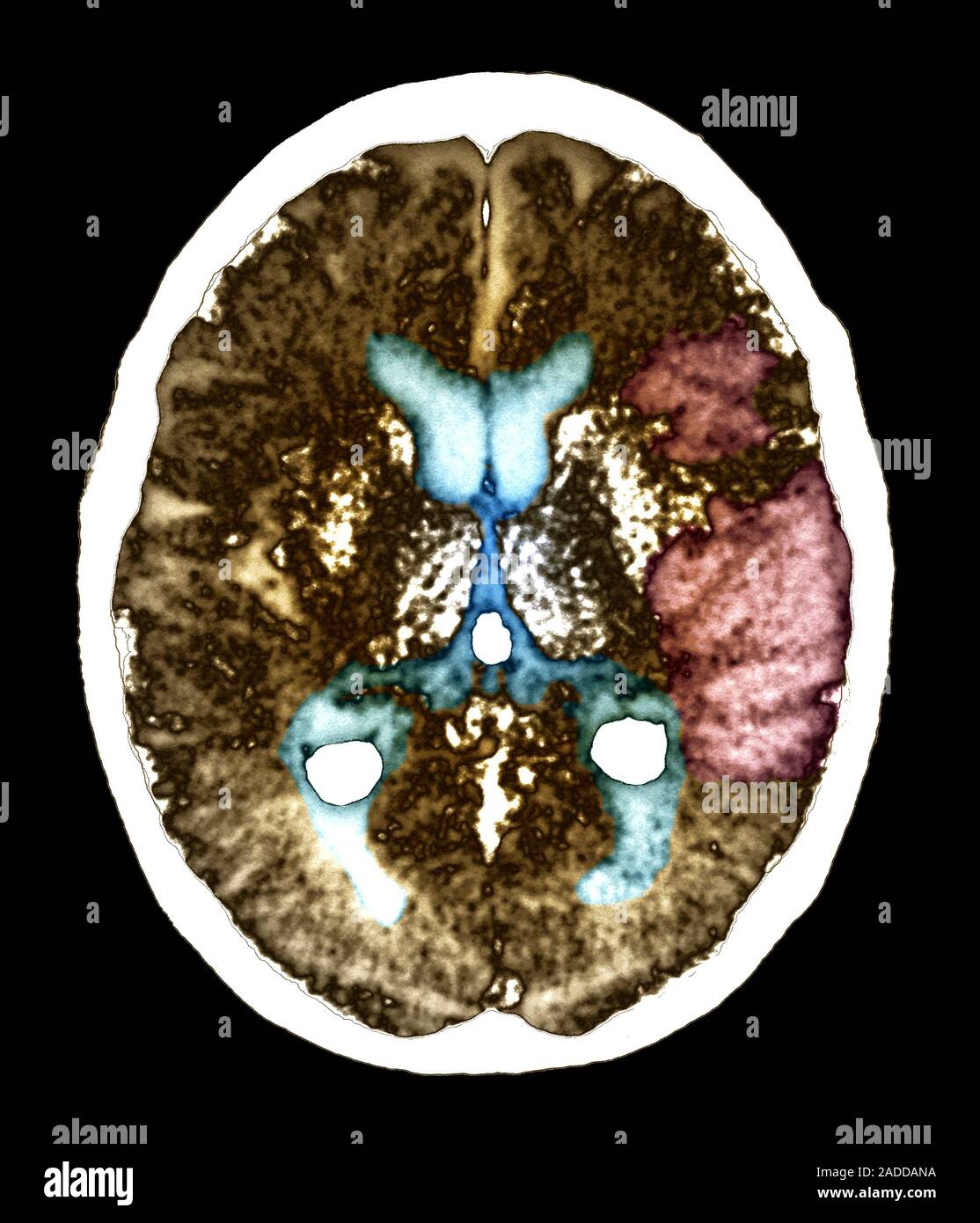 Stroke brain damage. Coloured axial computed tomography (CT) scan through the brain of a 69-year ...