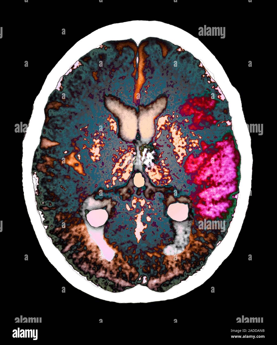 Stroke brain damage. Coloured axial computed tomography (CT) scan through the brain of a 69-year ...