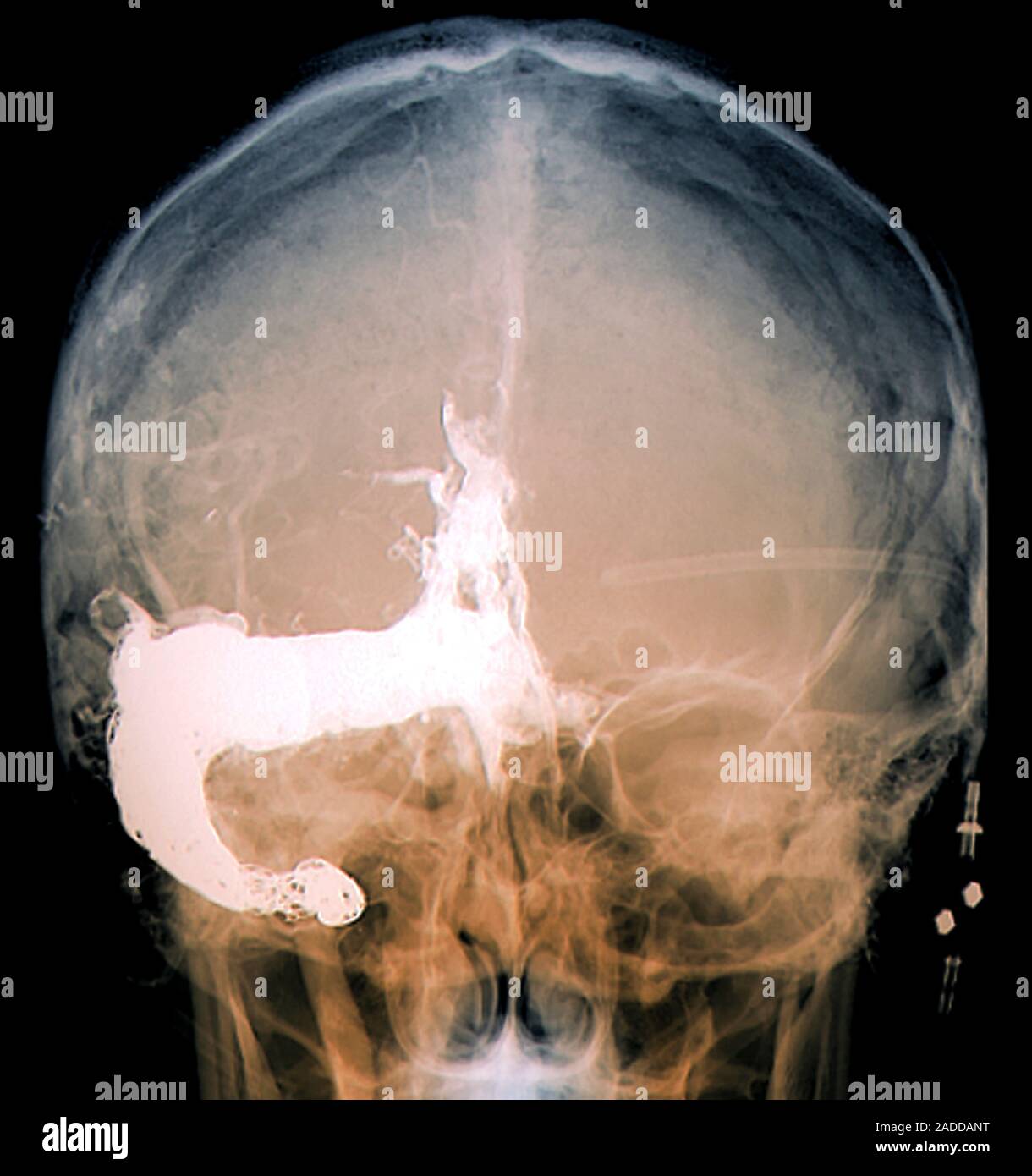Cerebral arteriovenous malformation treatment. Frontal coloured X-ray ...