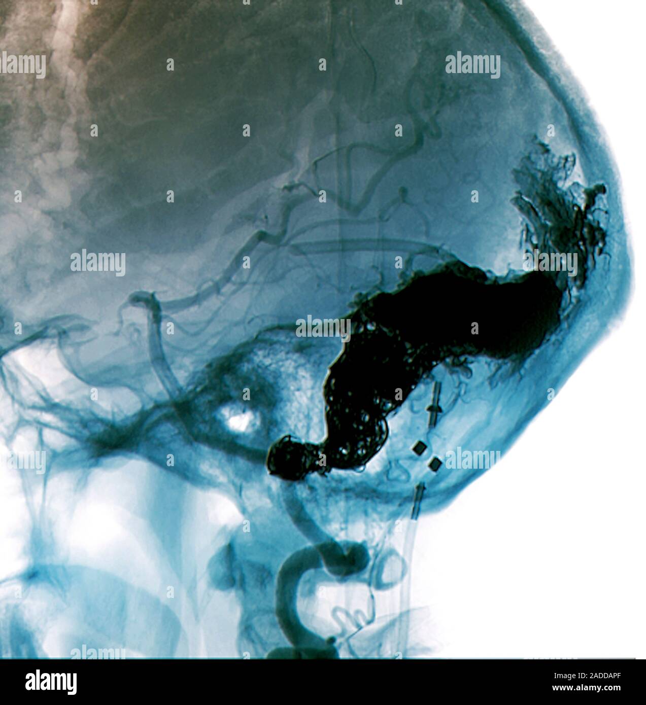 Cerebral arteriovenous malformation treatment. Coloured lateral X-ray ...