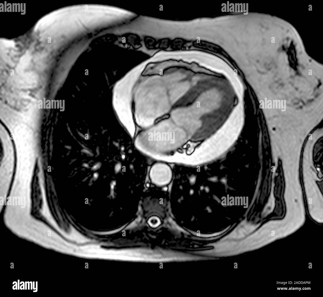 Chronic pericarditis. Axial magnetic resonance imaging (MRI) scan of ...