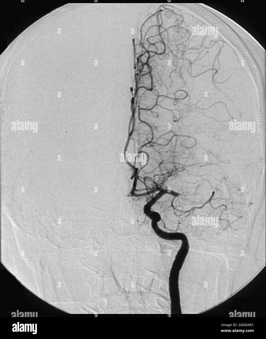 Brain arteries before stroke treatment. Angiogram of arteries in the ...