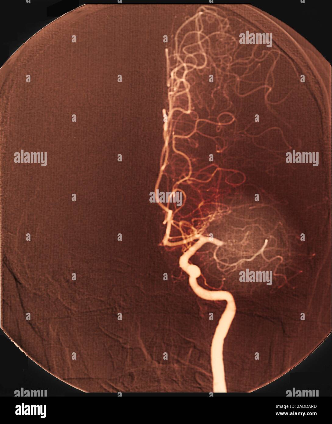 Brain arteries before stroke treatment. Coloured angiogram of arteries ...