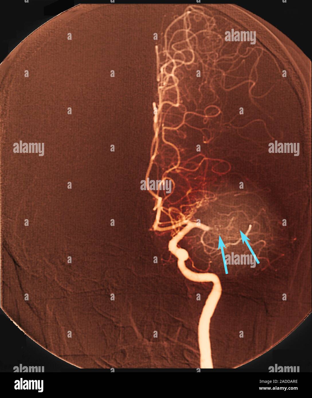 Brain arteries before stroke treatment. Coloured angiogram of arteries ...