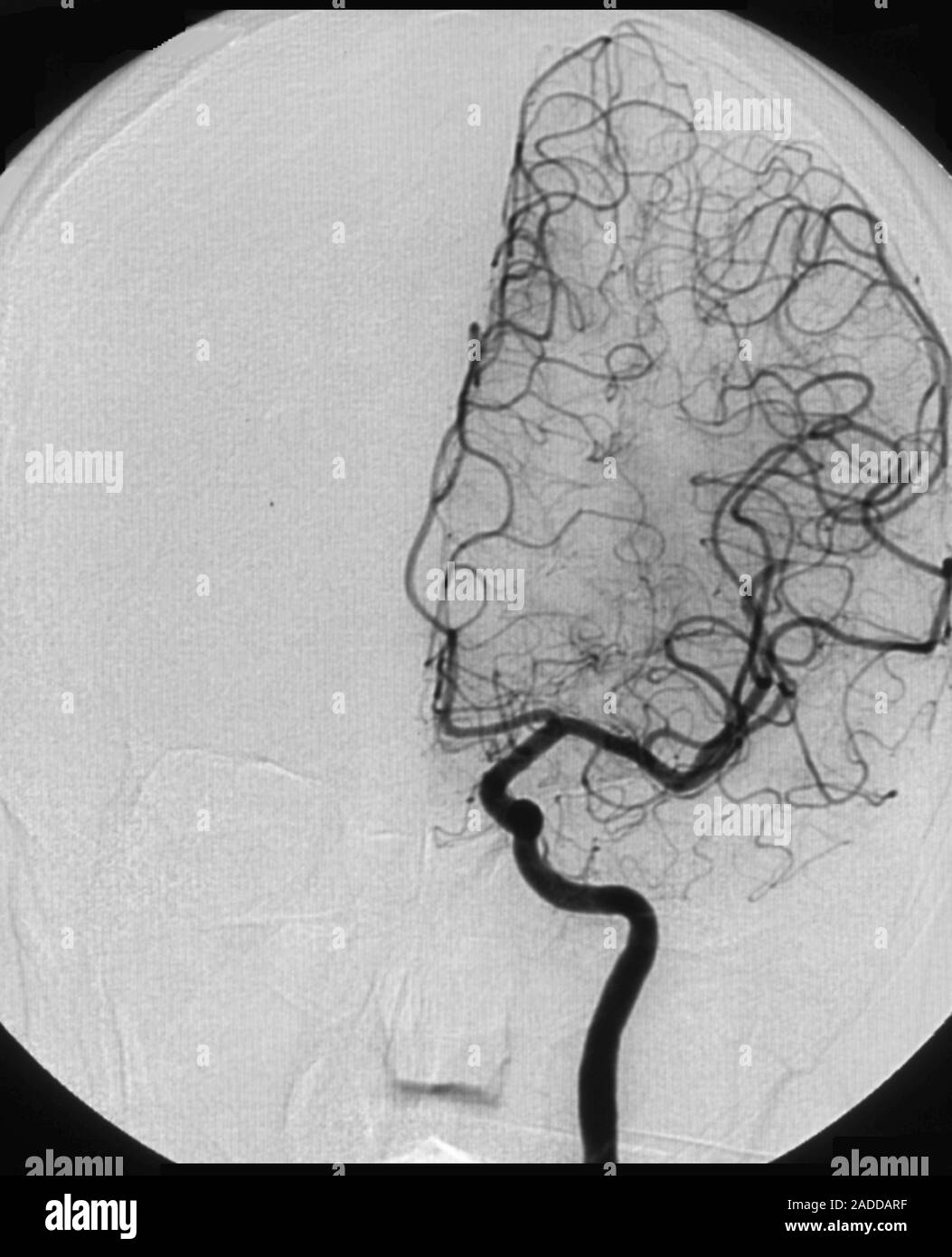 Brain arteries after stroke treatment. Angiogram of arteries in the ...